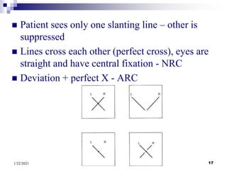 Maddox rod, Maddox wing, Bagolini striated glasses, RAF ruler and Prism ...