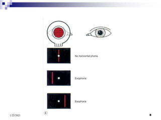 Maddox rod, Maddox wing, Bagolini striated glasses, RAF ruler and Prism ...