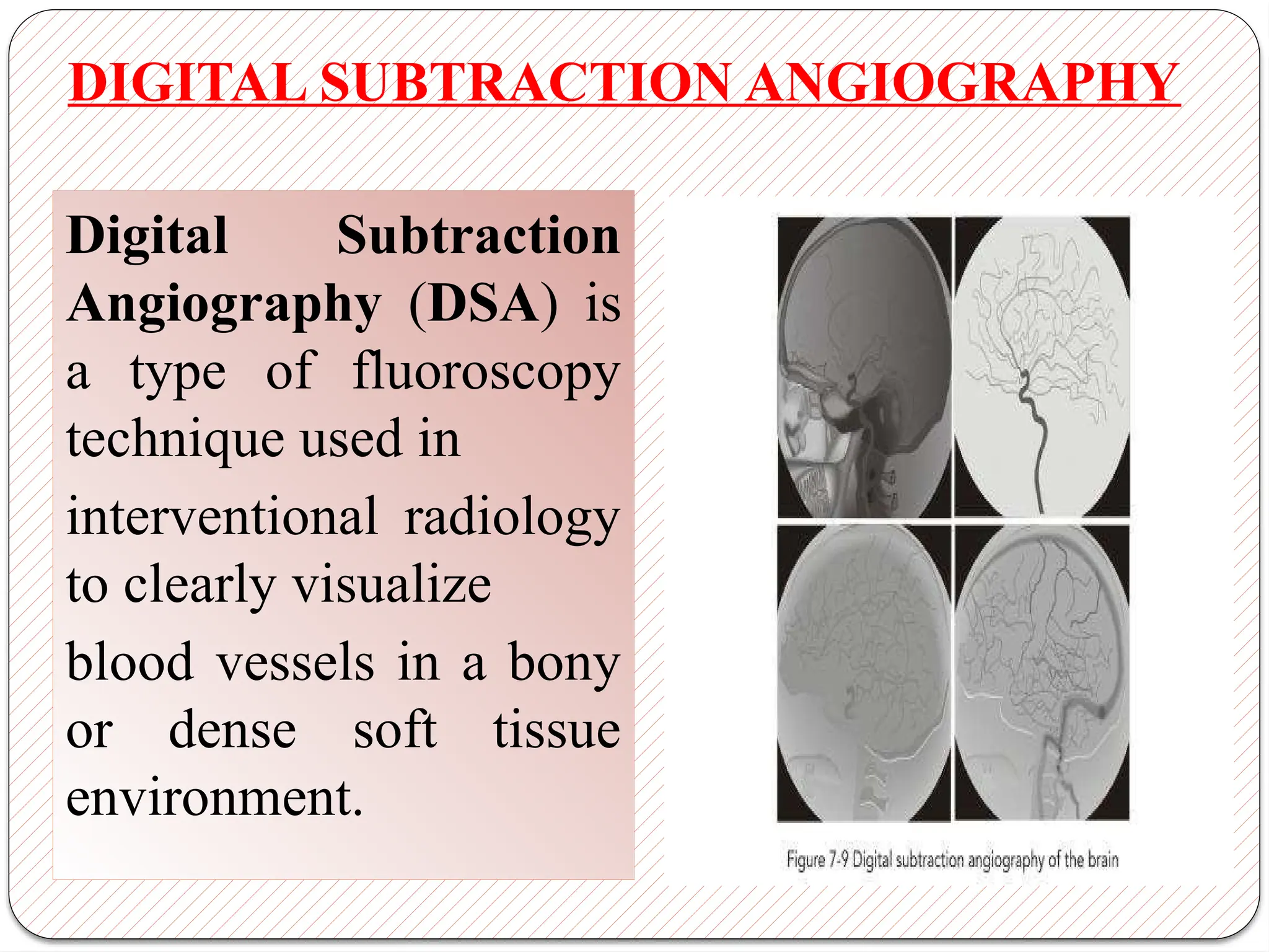 BHANU PRATAP DSA new.pptx digital subtraction angiography | PPTX