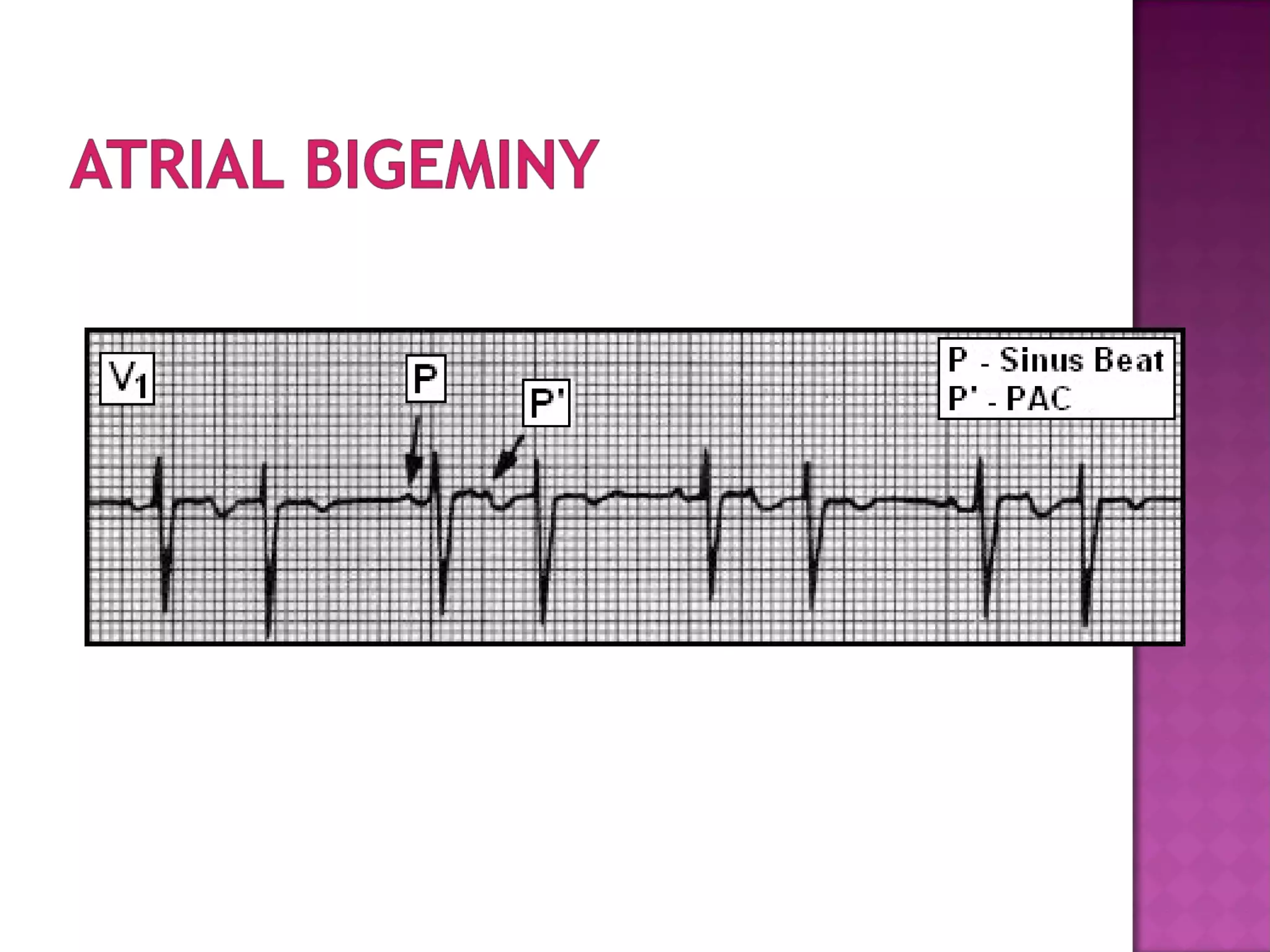 ECG: Multifocal Atrial Tachycardia | PPT