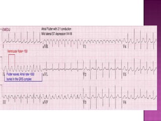 ECG: Multifocal Atrial Tachycardia | PPT