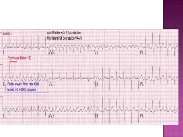 ECG: Multifocal Atrial Tachycardia | PPT | Heart and Cardiovascular ...