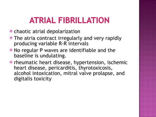 ECG: Multifocal Atrial Tachycardia | PPT