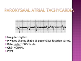 ECG: Multifocal Atrial Tachycardia | PPT