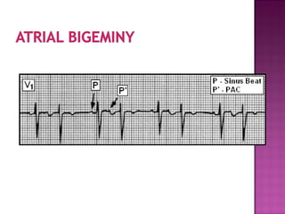 ECG: Multifocal Atrial Tachycardia | PPT