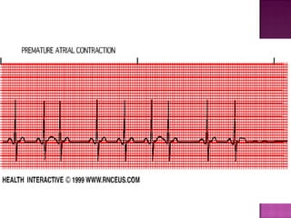 ECG: Multifocal Atrial Tachycardia | PPT
