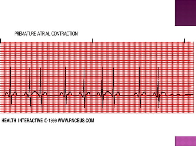 ECG: Multifocal Atrial Tachycardia | PPT | Heart and Cardiovascular ...