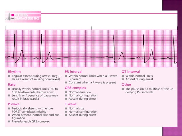 ECG: Multifocal Atrial Tachycardia | PPT | Heart and Cardiovascular ...