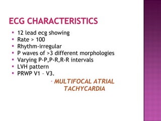 ECG: Multifocal Atrial Tachycardia | PPT