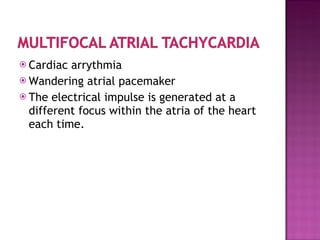 ECG: Multifocal Atrial Tachycardia | PPT