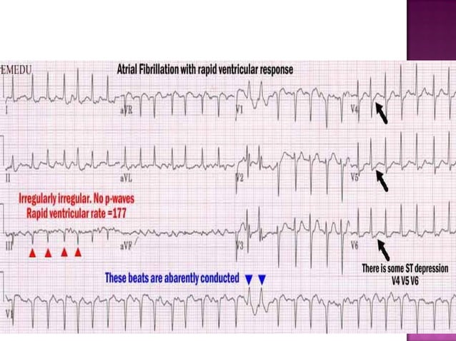 ECG: Multifocal Atrial Tachycardia