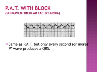 Paroxysmal Atrial Tachycardia Pat