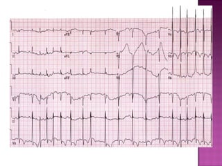 Multifocal Atrial Tachycardia Ecg