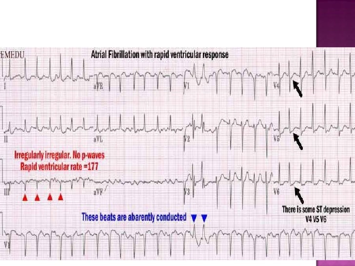 ECG: Multifocal Atrial Tachycardia