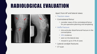 FEMUR Fracture - Anatomy and Management Options | PPTX