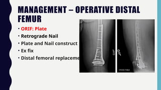FEMUR Fracture - Anatomy and Management Options | PPTX