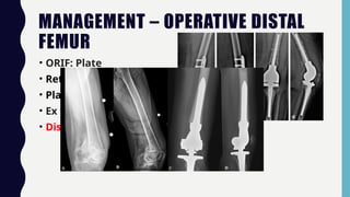 FEMUR Fracture - Anatomy and Management Options | PPTX