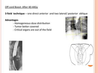 Esophageal cancer-role of RT | PPTX