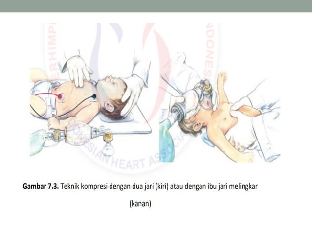 BANTUAN HIDUP DASAR PADA DEWASA, ANAK DAN BAYI.pptx