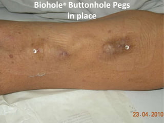 Bioholes® for buttonholing in Dialysis | PPT
