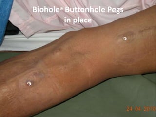 Bioholes® for buttonholing in Dialysis | PPT