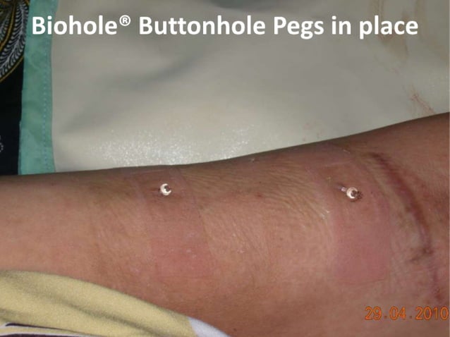 Bioholes® for buttonholing in Dialysis | PDF