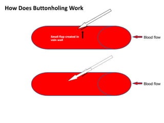 Bioholes® for buttonholing in Dialysis | PPT