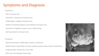 Inguinal hernia detailed about hernia all | PPT