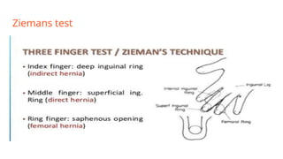Inguinal hernia detailed about hernia all | PPTX