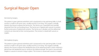 Inguinal hernia detailed about hernia all | PPT