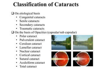Bhupi clinical genetics cataract | PPTX