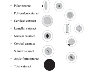 Bhupi clinical genetics cataract | PPTX