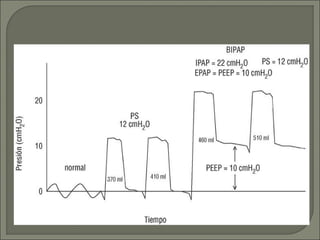 Bi level ventilation support | PPT