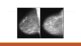 BI-RADS (MAMMOGRAPHY) | PPTX