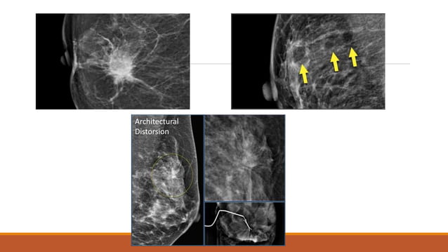 BI-RADS (MAMMOGRAPHY) | PPTX