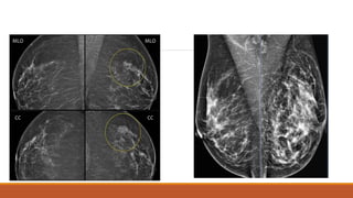 BI-RADS (MAMMOGRAPHY) | PPTX