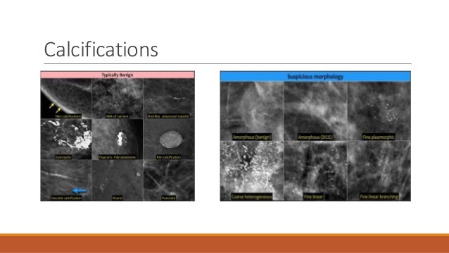 BI-RADS (MAMMOGRAPHY)