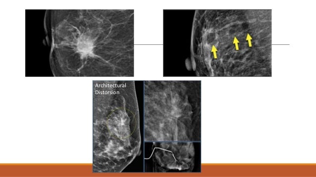 BI-RADS (MAMMOGRAPHY)