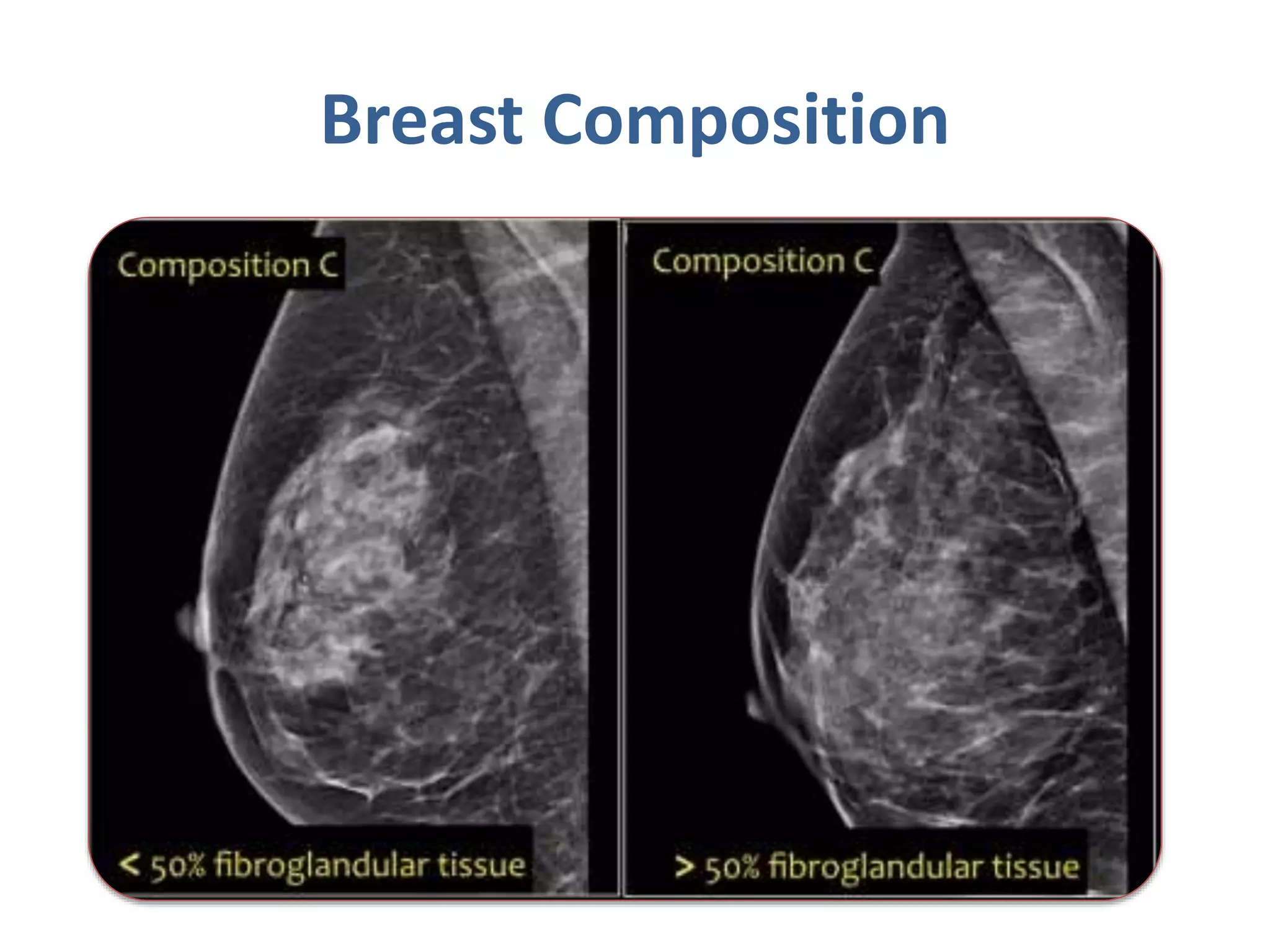 Bi Rads Breast | PPTX