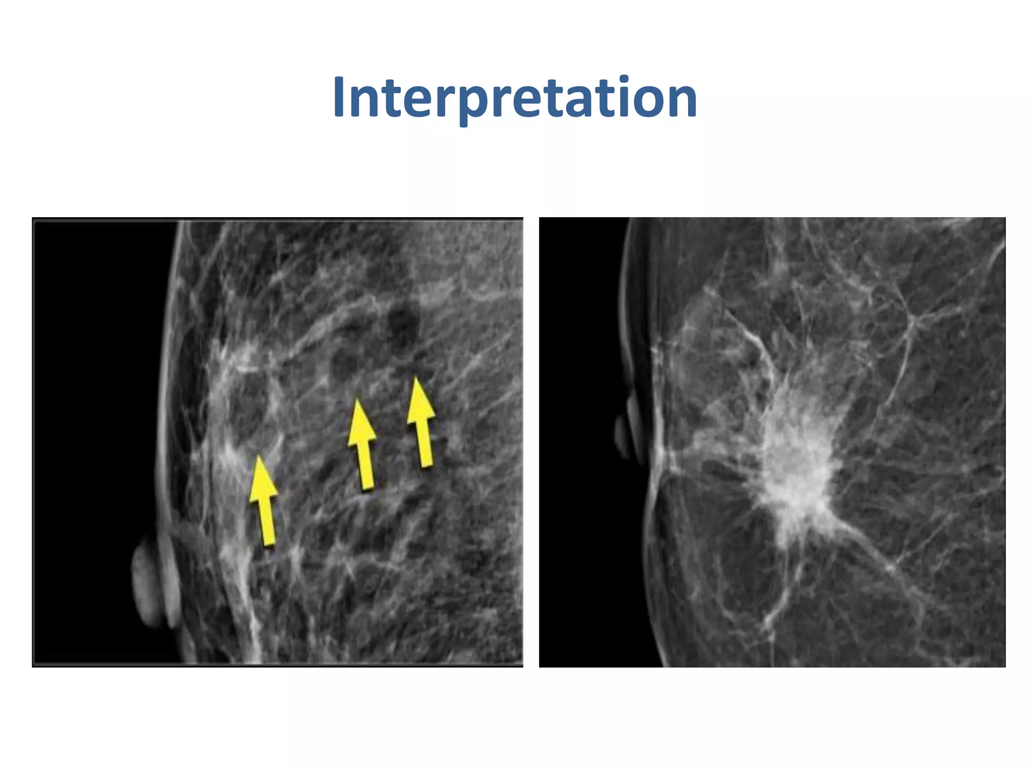 Bi Rads Breast | PPTX