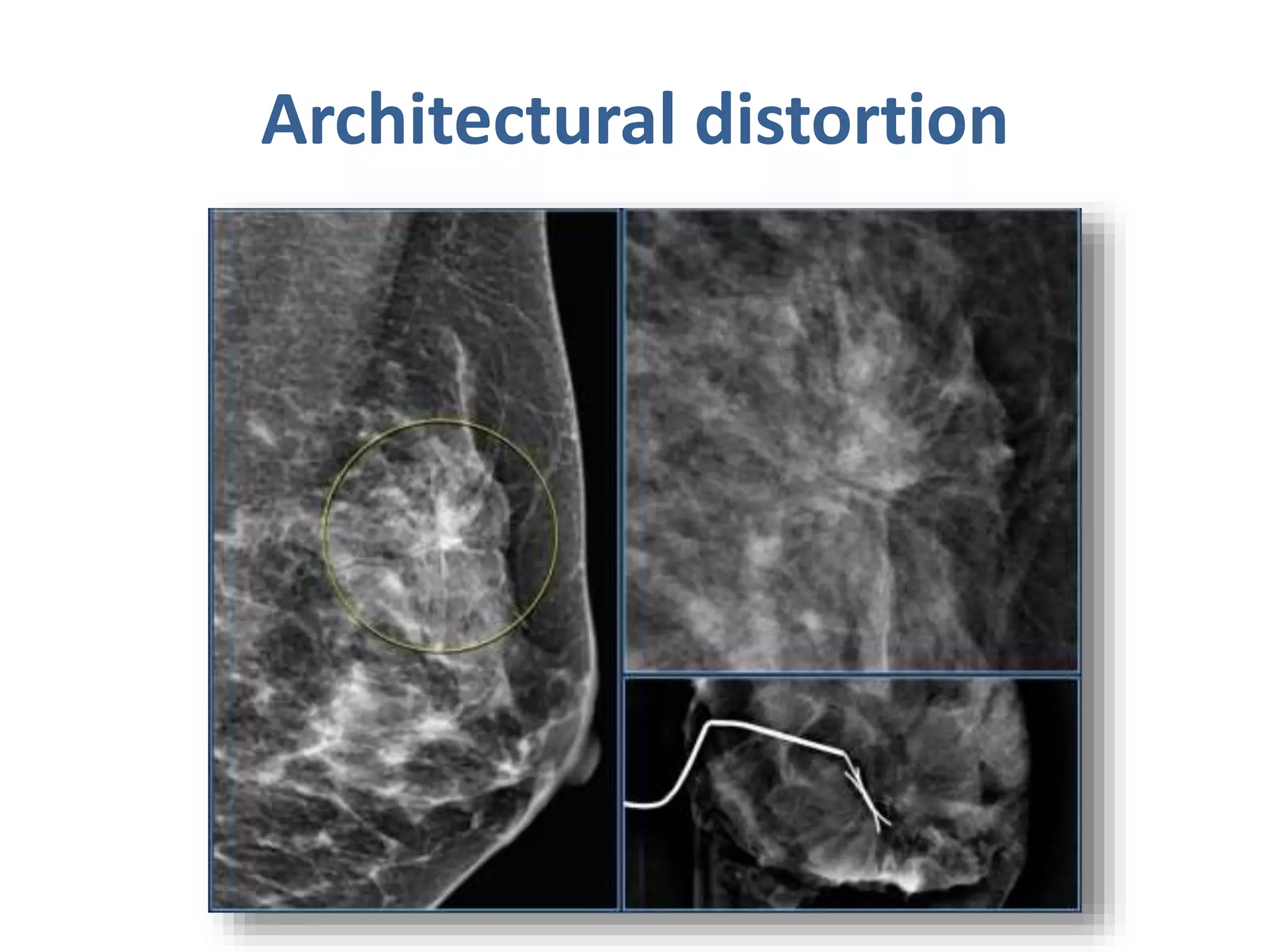 Bi Rads Breast | PPTX