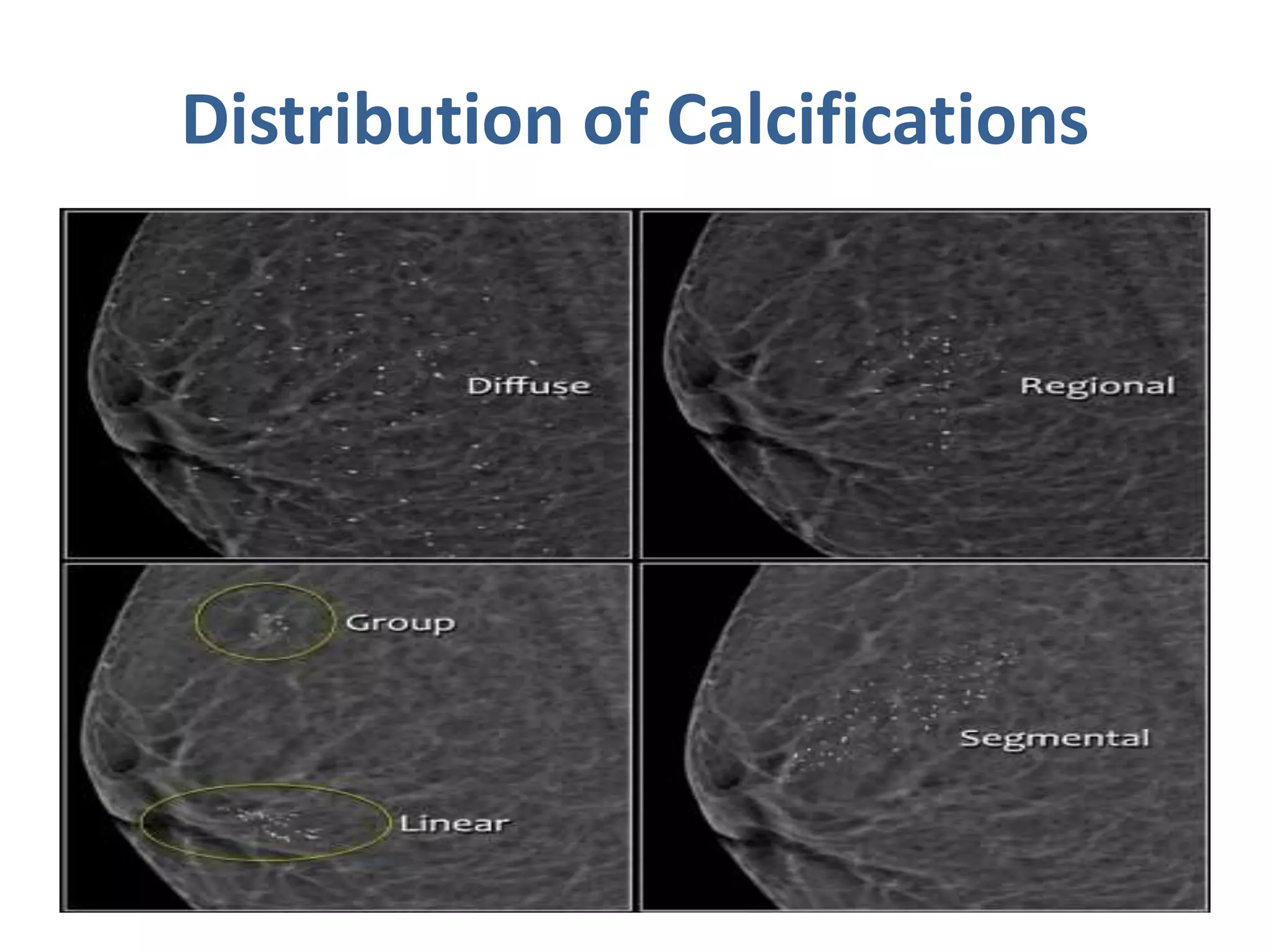 Bi Rads Breast | PPTX