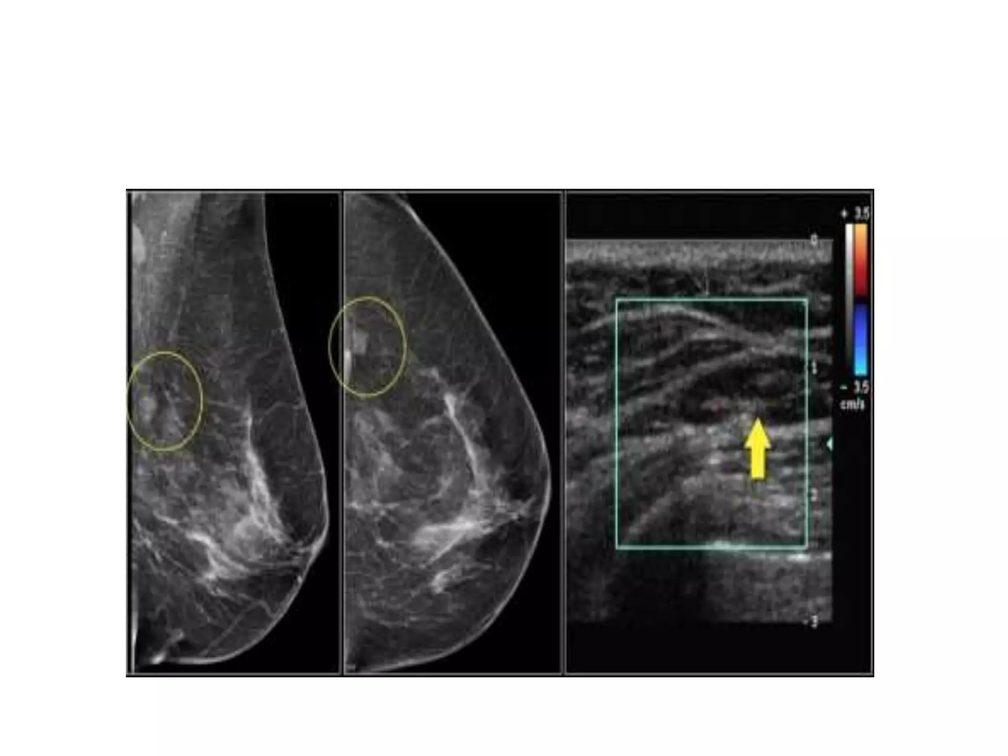 Bi Rads Breast | PPTX