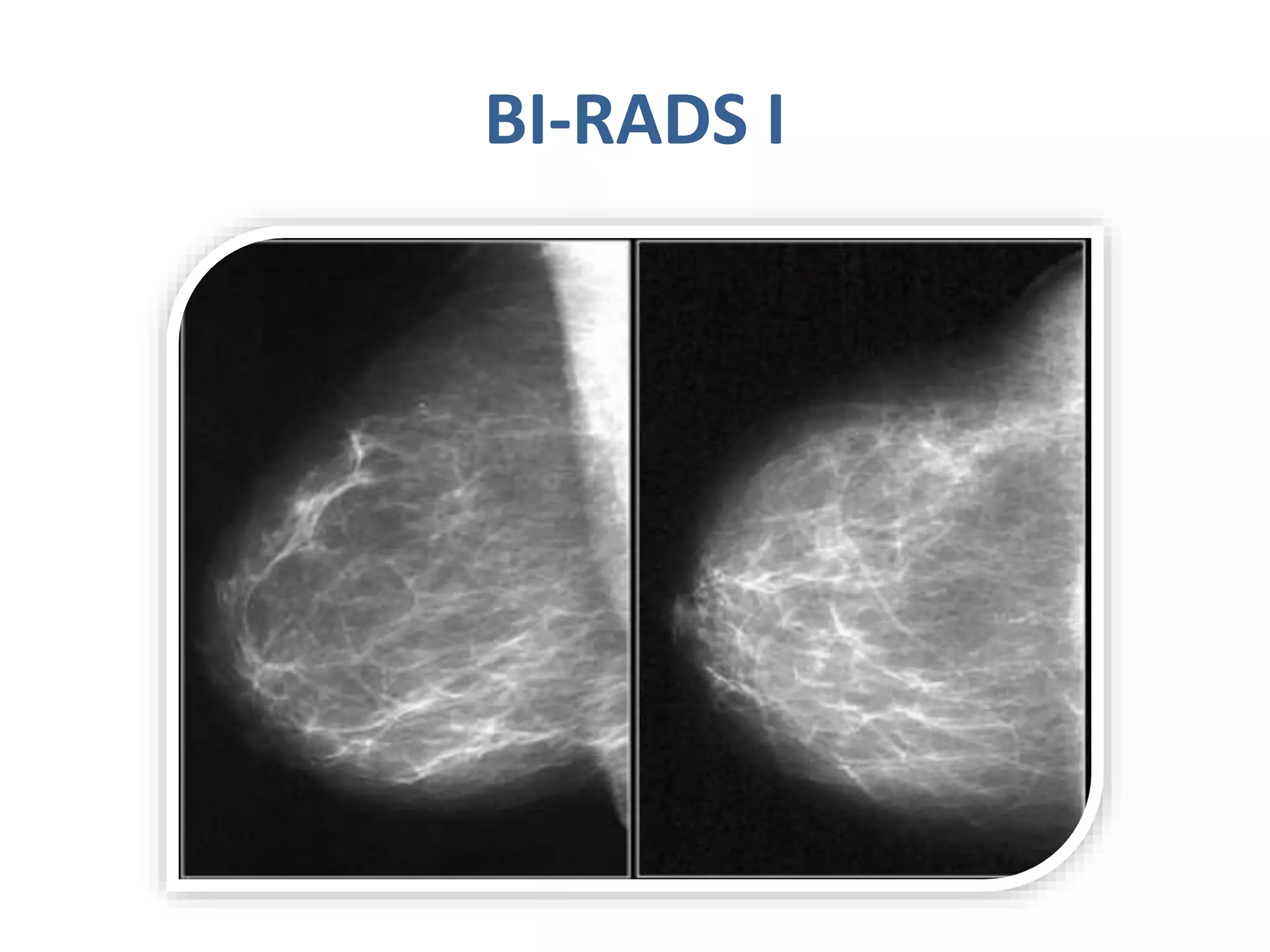 Bi Rads Breast | PPTX