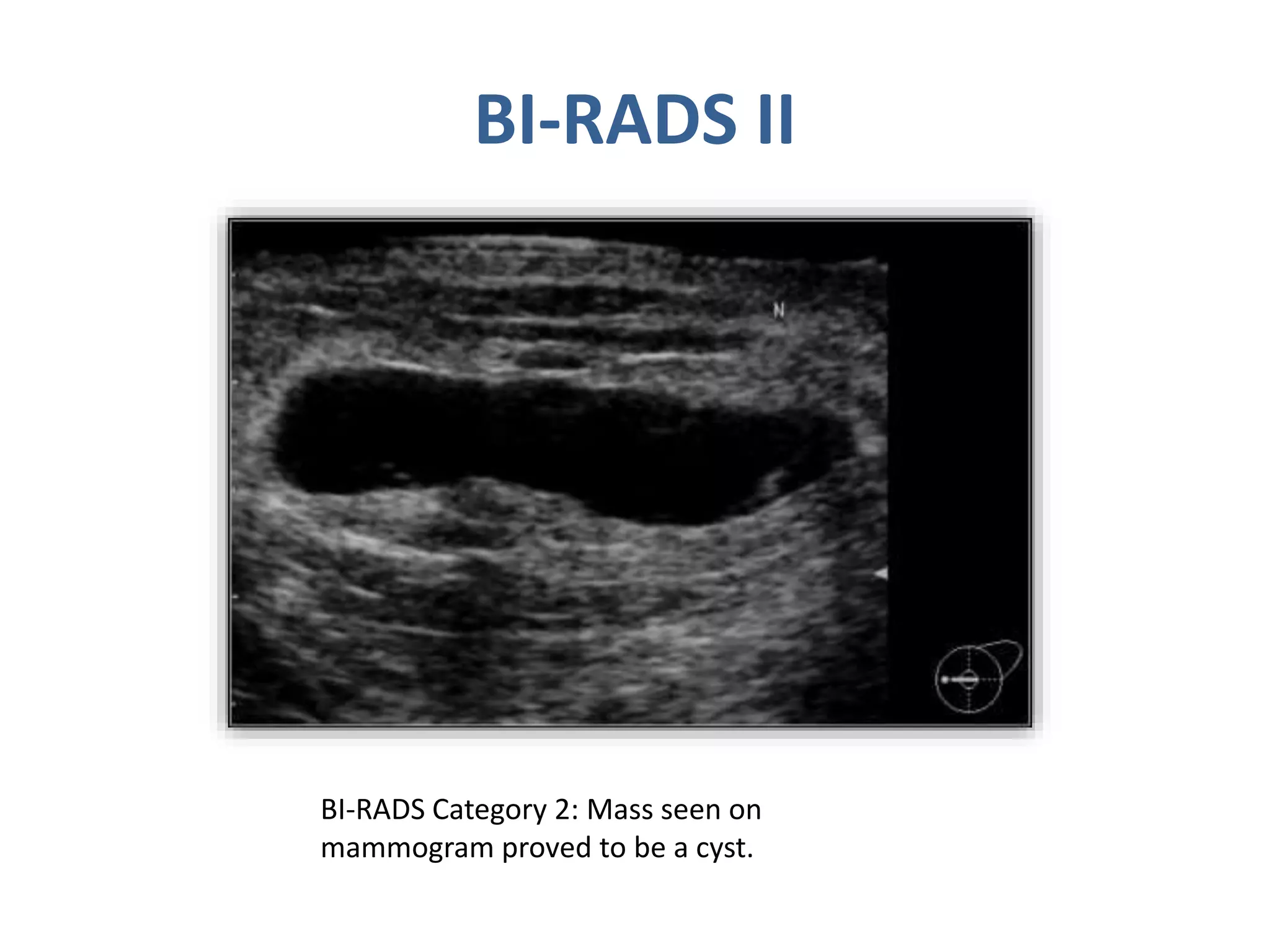 Bi Rads Breast | PPTX