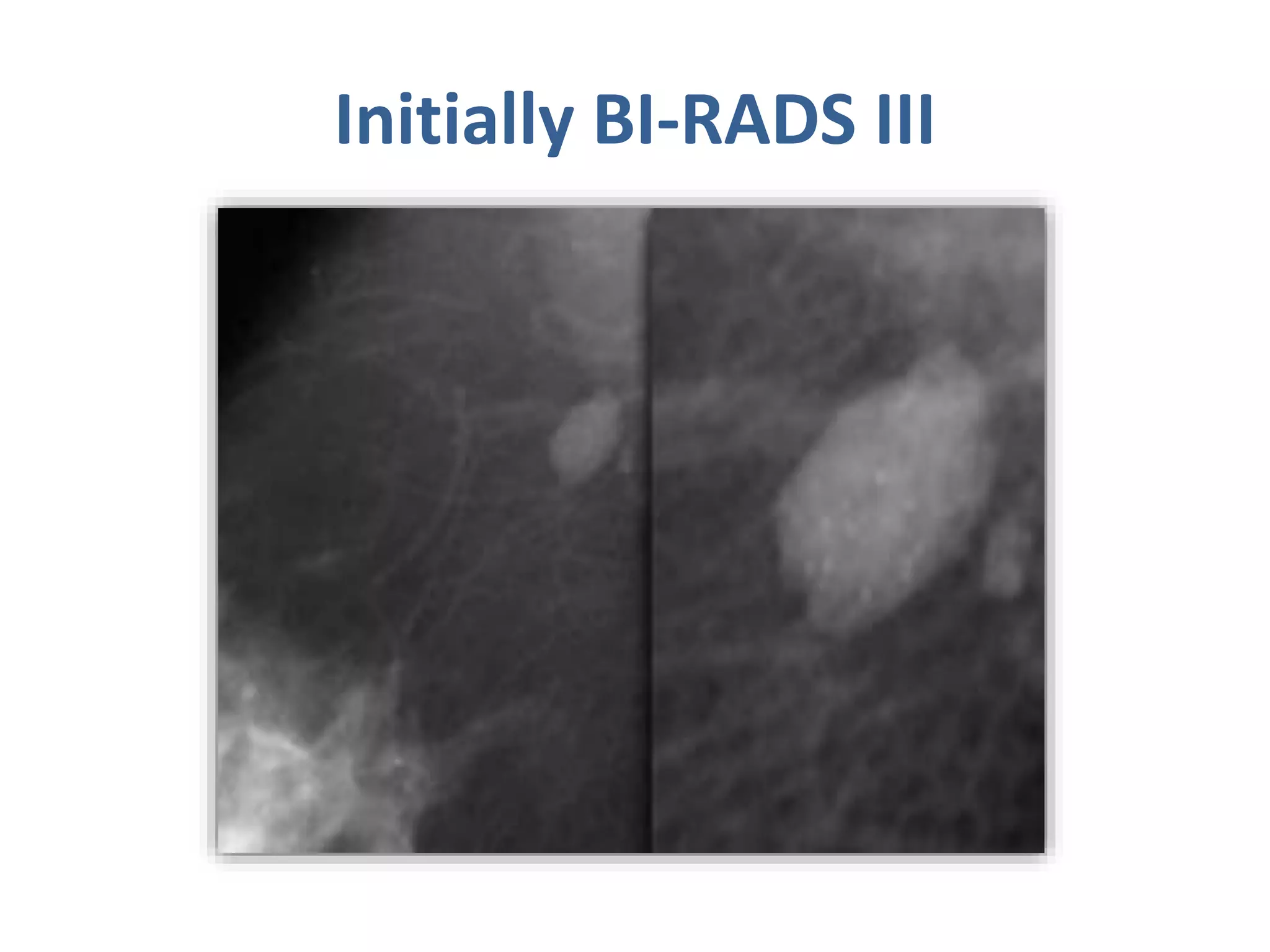 Bi Rads Breast | PPTX