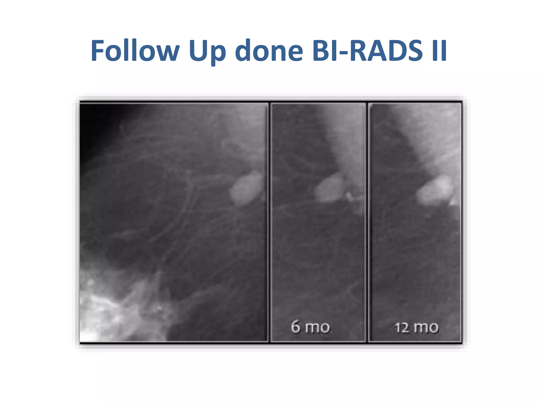 Bi Rads Breast | PPTX