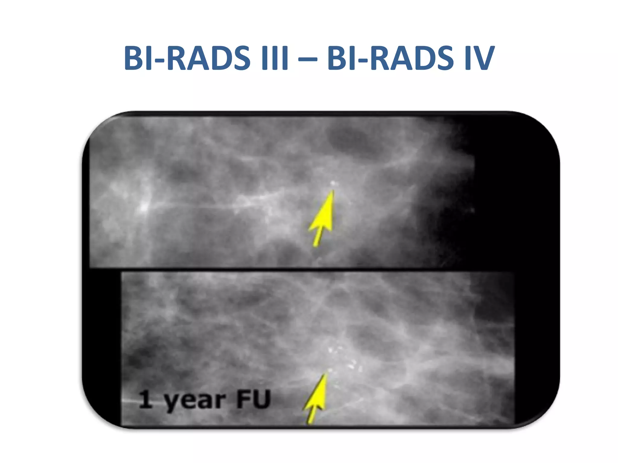 Bi Rads Breast | PPTX