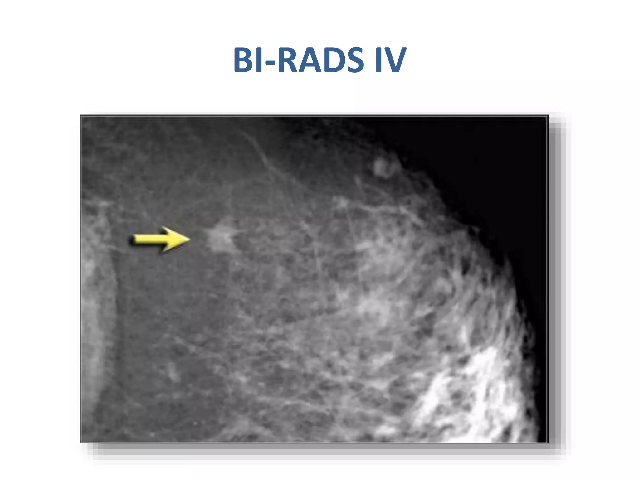 Bi Rads Breast | PPTX