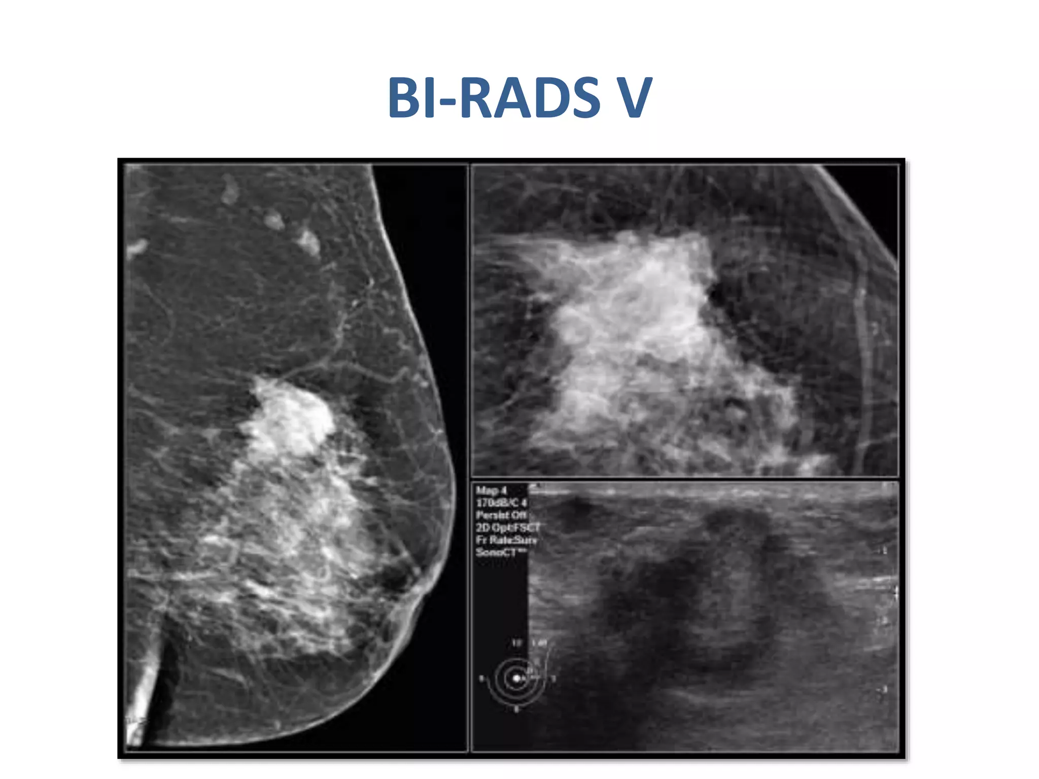 Bi Rads Breast | PPTX